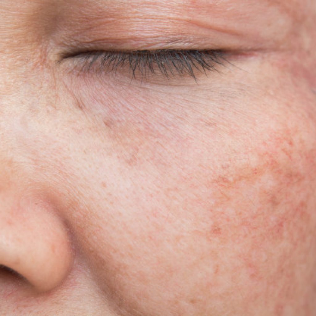 Melasma e Manchas - Clínica Médica Lu Dermatologia e Oftalmologia